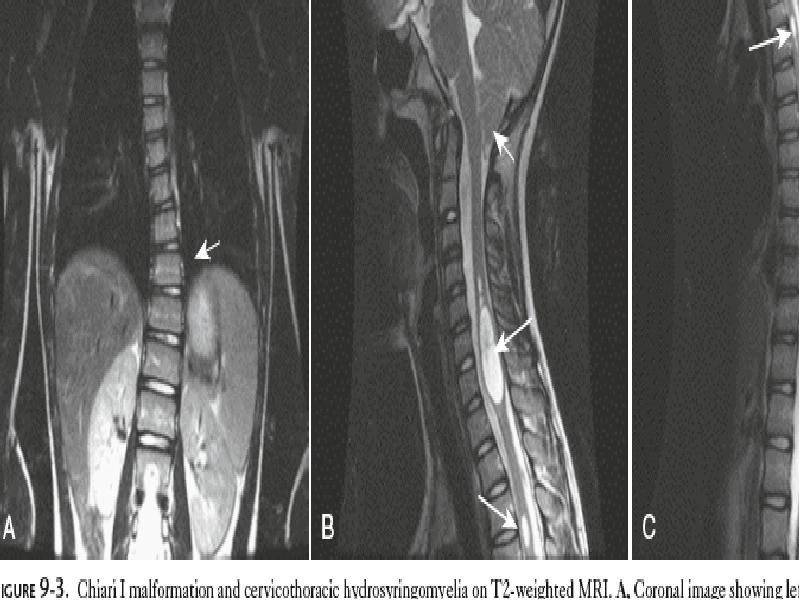 Radiological imaging of congenital anomalies of the spine and spinal cord.
