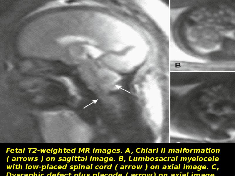 Radiological imaging of congenital anomalies of the spine and spinal cord.