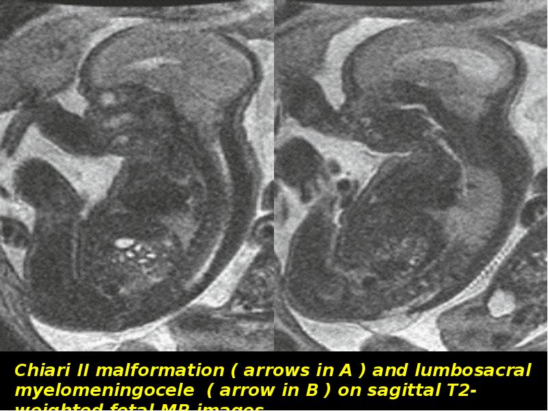 Radiological imaging of congenital anomalies of the spine and spinal cord.