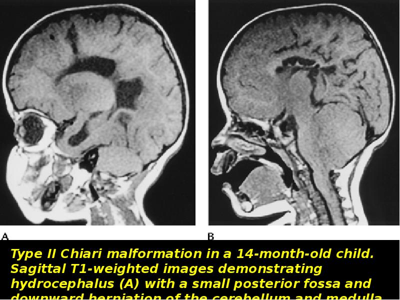 Radiological imaging of congenital anomalies of the spine and spinal cord.