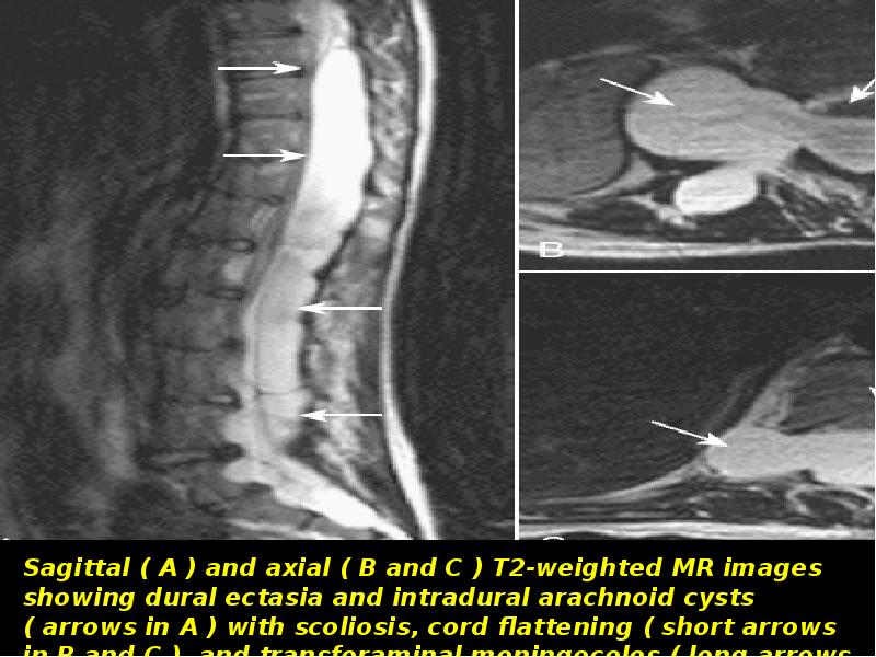 Radiological imaging of congenital anomalies of the spine and spinal cord.