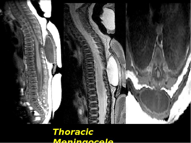Radiological imaging of congenital anomalies of the spine and spinal cord.