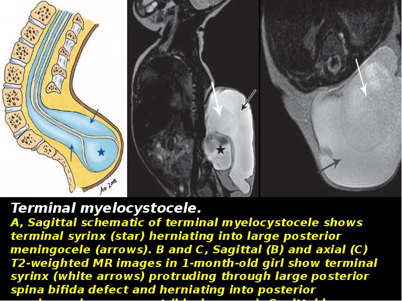 Radiological imaging of congenital anomalies of the spine and spinal cord.