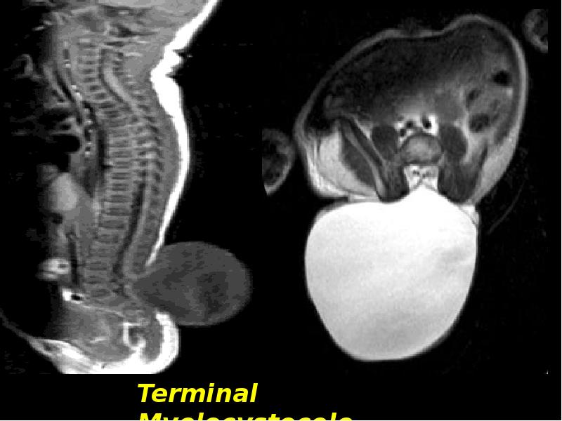 Radiological imaging of congenital anomalies of the spine and spinal cord.