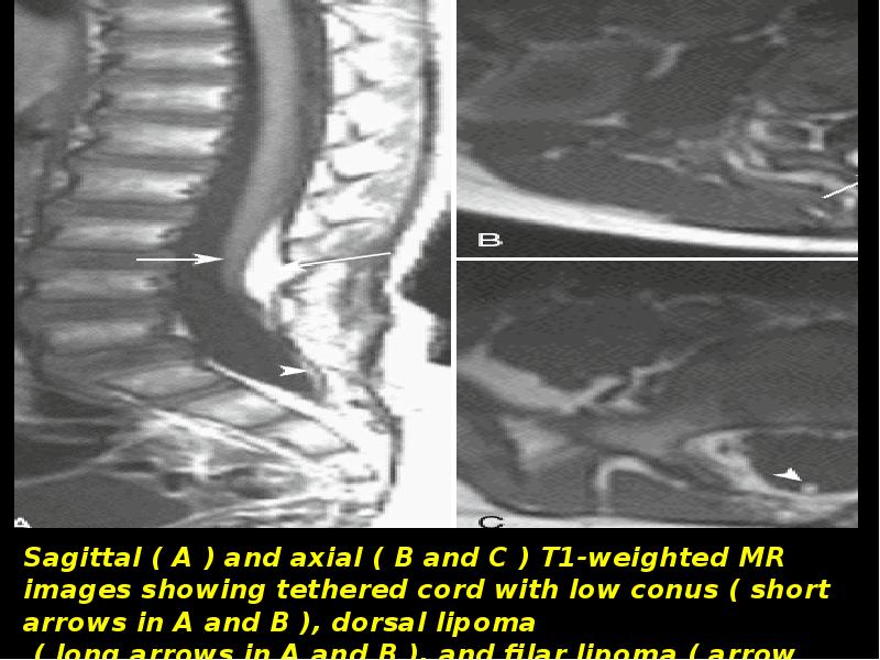 Radiological imaging of congenital anomalies of the spine and spinal cord.