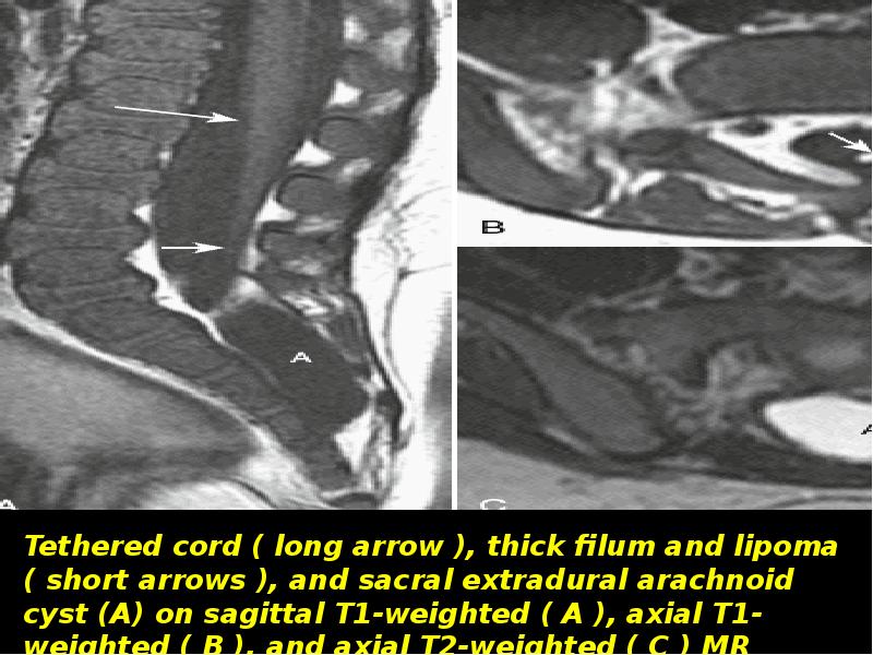 Radiological imaging of congenital anomalies of the spine and spinal cord.