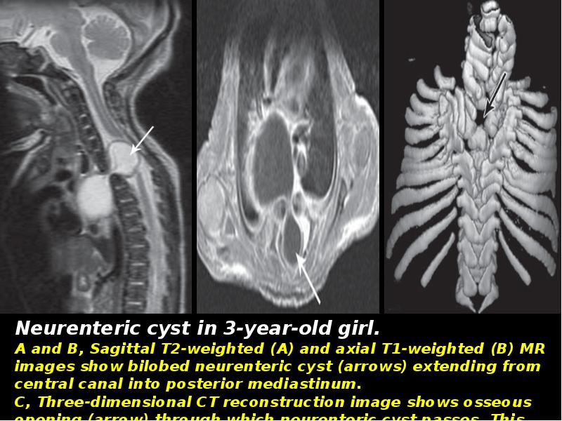 Radiological imaging of congenital anomalies of the spine and spinal cord.