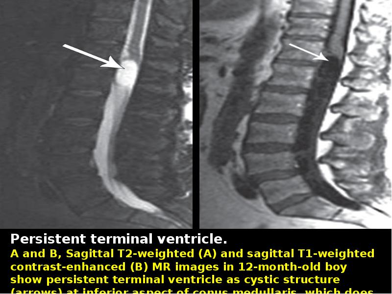 Radiological imaging of congenital anomalies of the spine and spinal cord.