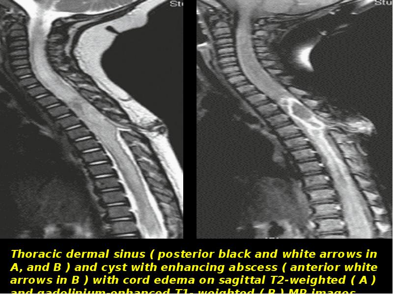 Radiological imaging of congenital anomalies of the spine and spinal cord.