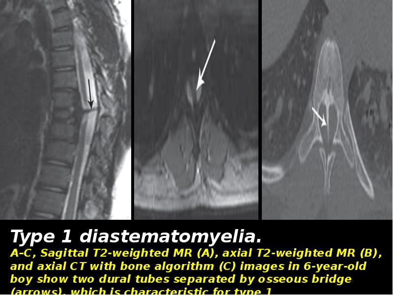 Radiological imaging of congenital anomalies of the spine and spinal cord.