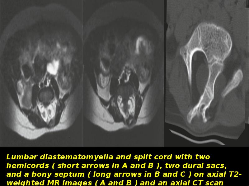 Radiological imaging of congenital anomalies of the spine and spinal cord.