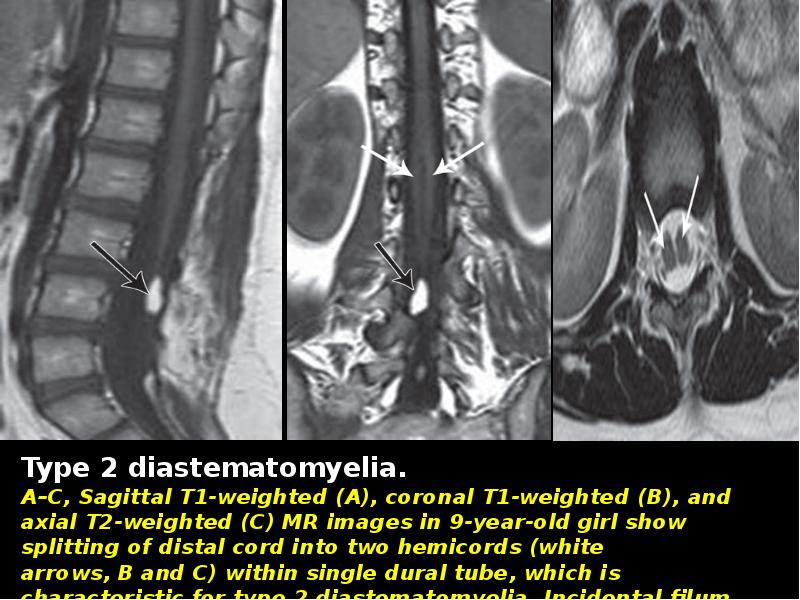 Radiological imaging of congenital anomalies of the spine and spinal cord.