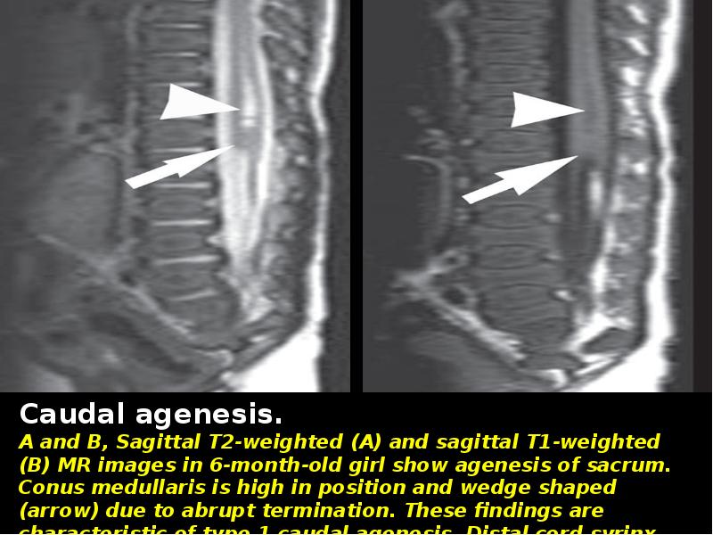 Radiological imaging of congenital anomalies of the spine and spinal cord.