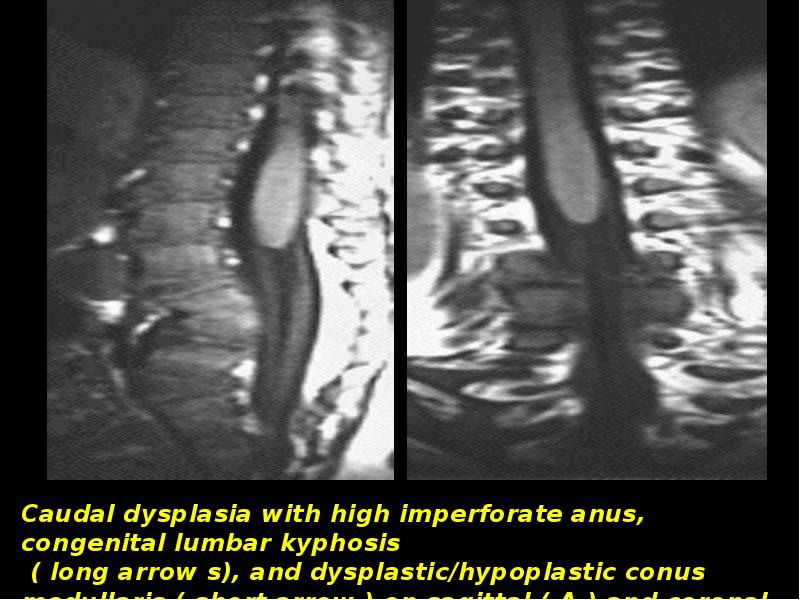 Radiological imaging of congenital anomalies of the spine and spinal cord.