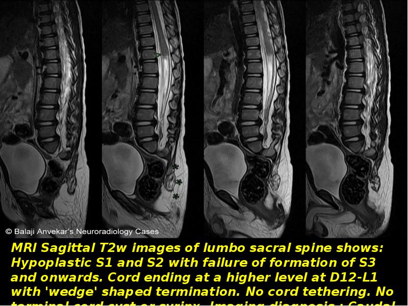Radiological imaging of congenital anomalies of the spine and spinal cord.