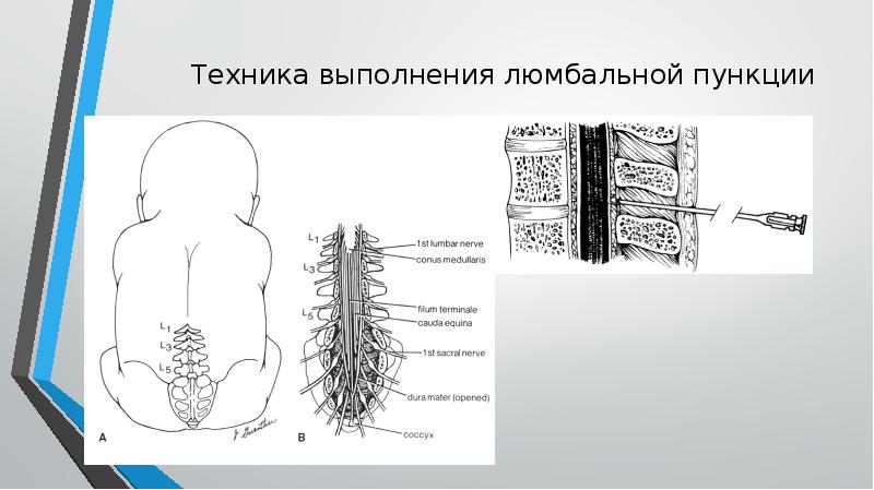 Люмбальная пункция