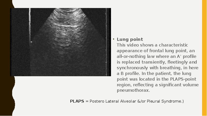The BLUE Bedside Lung Ultrasound in Emergency -Protocol and the ...