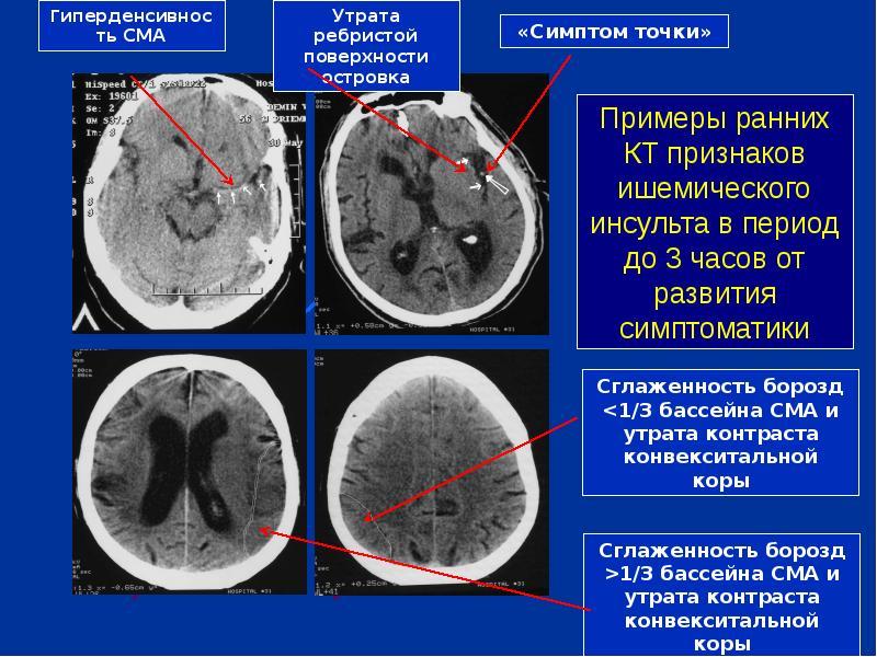 Ишемический инфаркт мозга