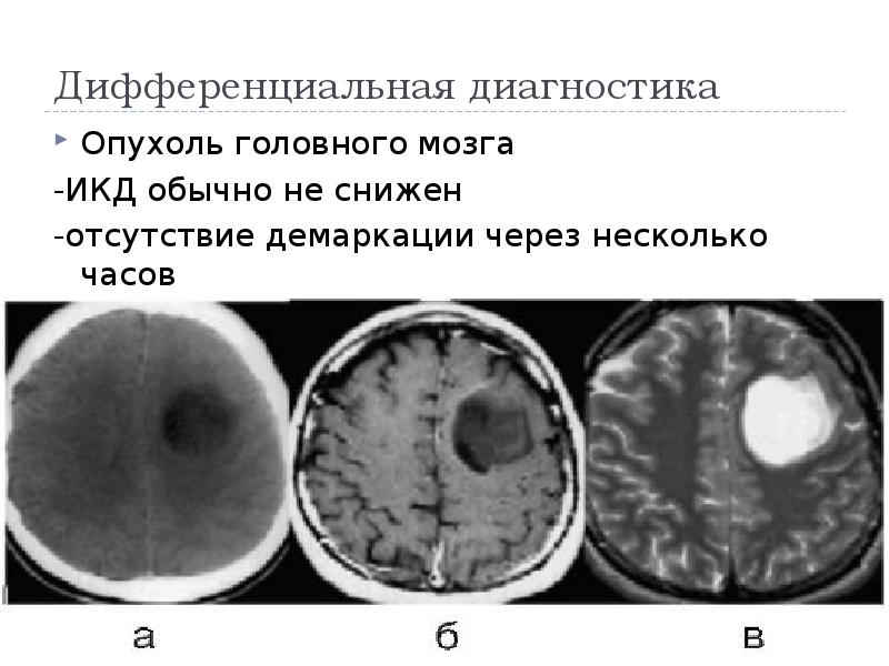 Ишемический инфаркт мозга
