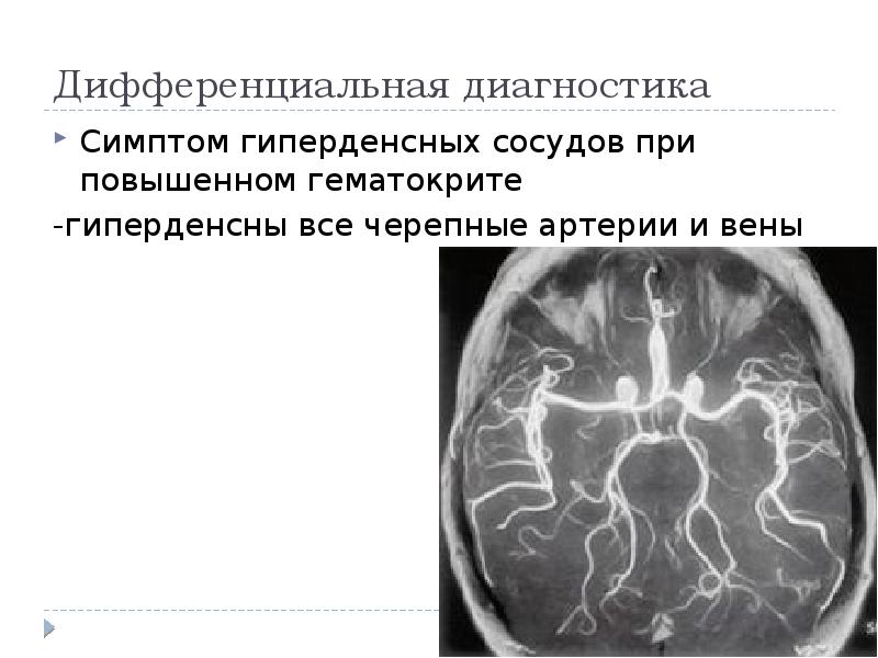 Ишемический инфаркт мозга