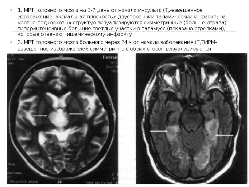 Ишемический инфаркт мозга