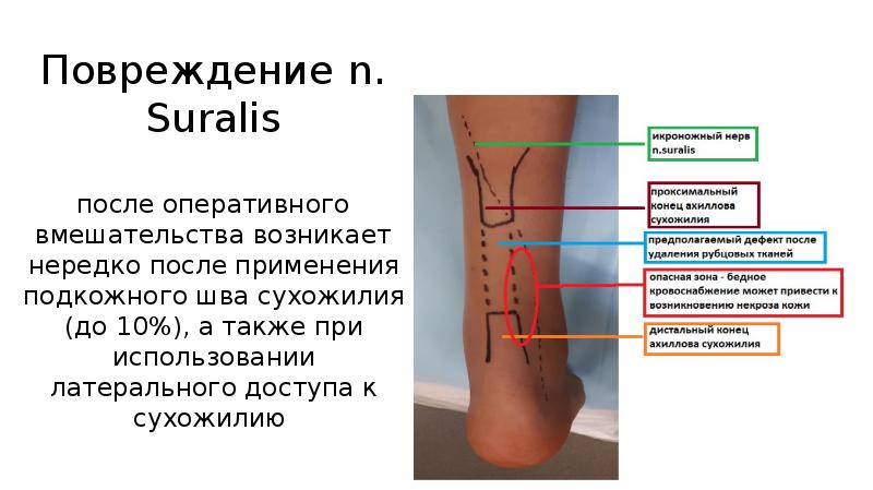 Анатомия ахиллова сухожилия