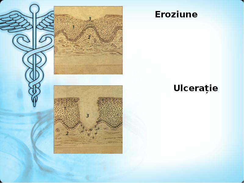 Diagnosticul diferen țial și tratamentul leziunilor eroziv-ulceroase ale