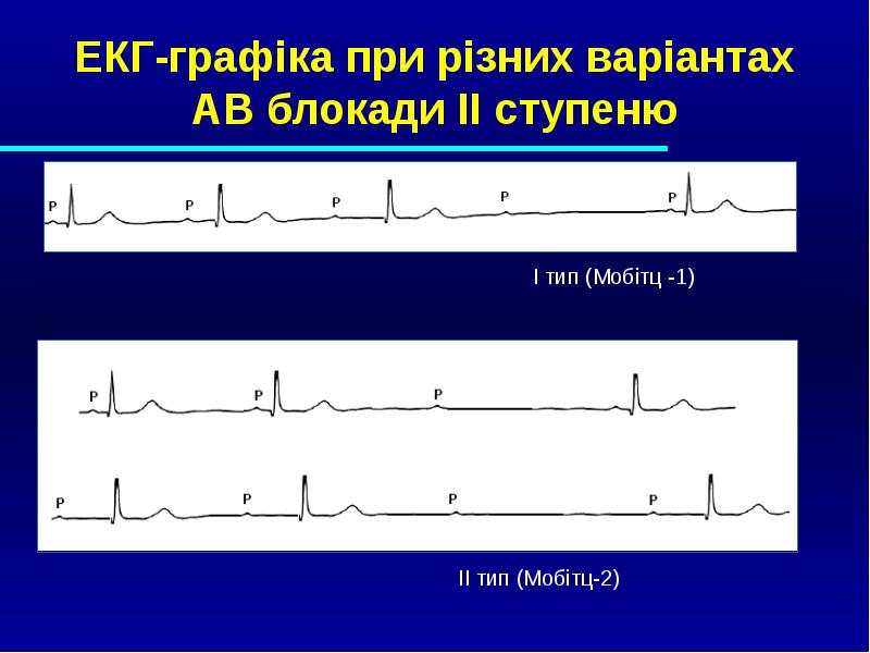 Клінічні та ЕКГ-ознаки порушень збудливості та провідності