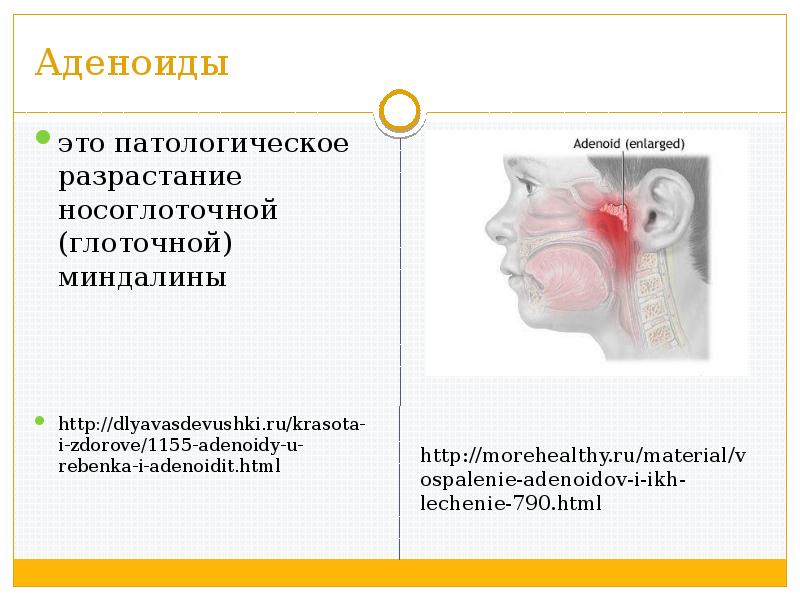 Аденоиды и аденоидит