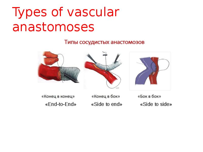 Vascular anastomoses