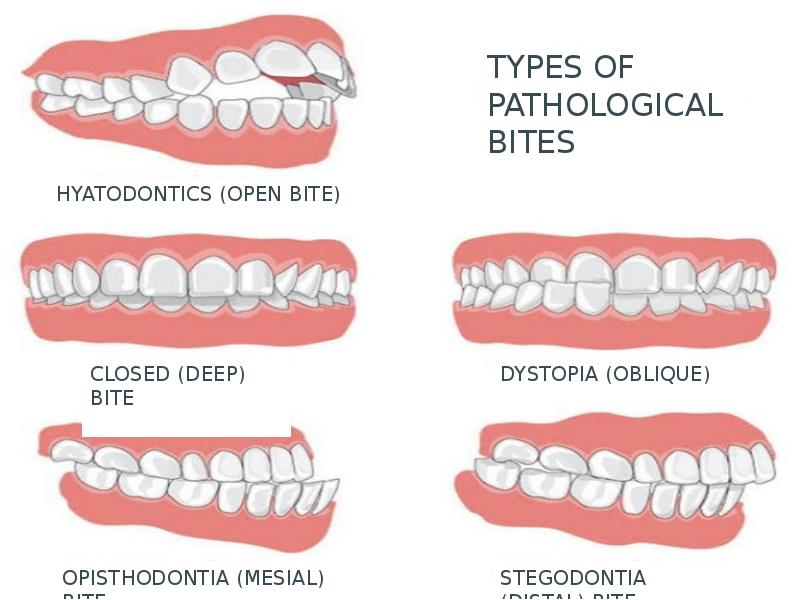 POSSIBLE OPTIONS FOR BITE CORRECTION. ORTHODONTIC PLATES AND BRACES