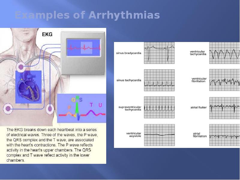 Cardiac Arrhythmias Done by: Islamova Sh. Group: 646 P. Checked by ...